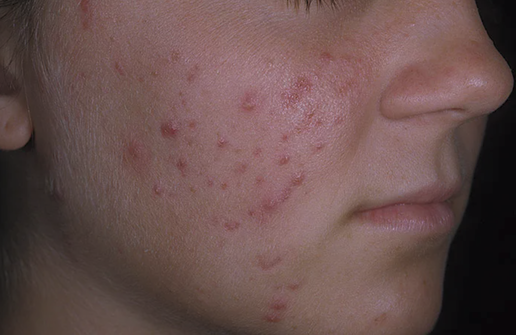 Pimple Face (1) - Varanasi Best Images Free Downloads